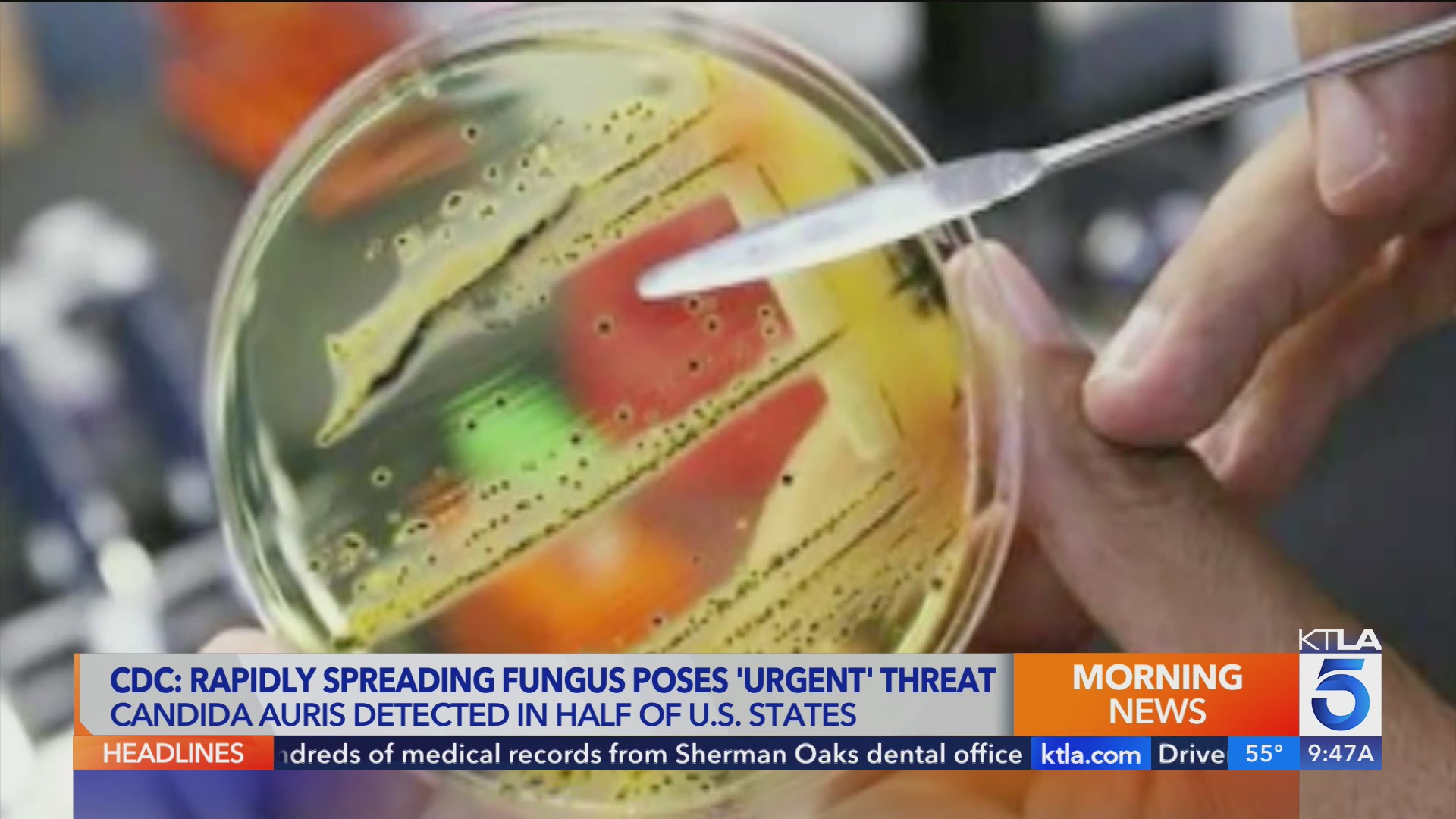Fungal expert explains CDC’s “urgent” warning about rapidly spreading ...