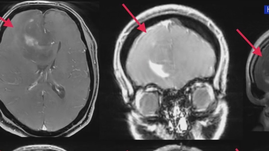 NJ man continues incredible recovery post brain surgery – PIX11