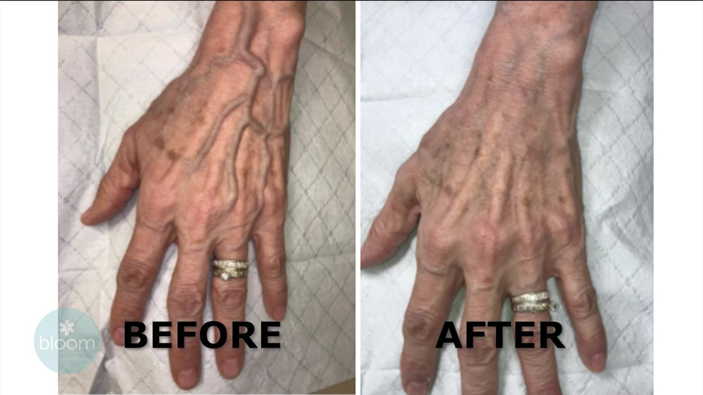 The Future of Vein Care Benefits Those Suffering With Bulging Hand ...