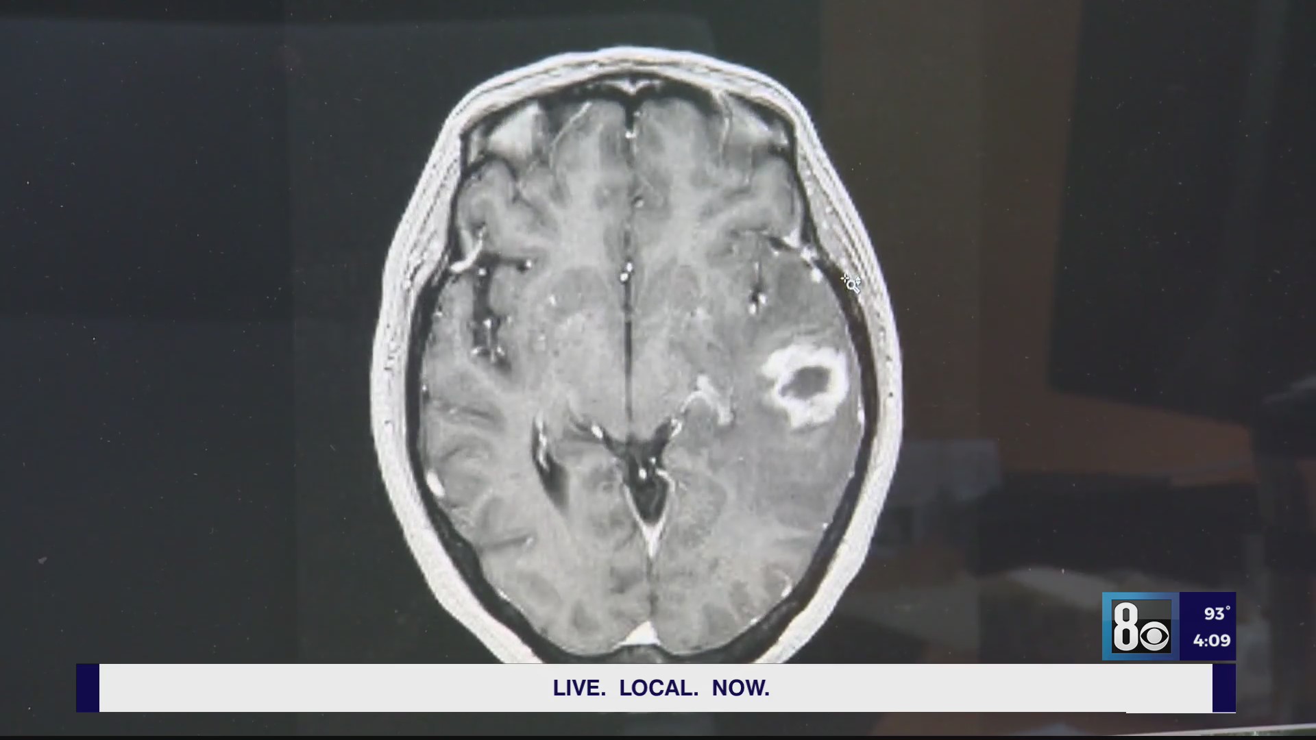Doctor offers hypothesis on what’s causing brain abscesses in Southern ...