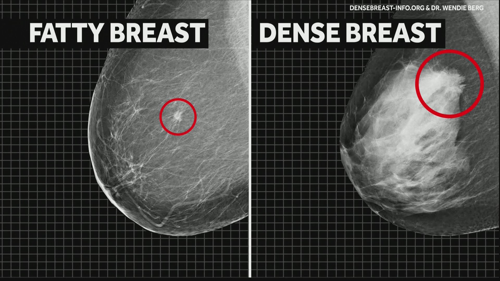 Dense Breast And Cancer What To Know Wsav Tv