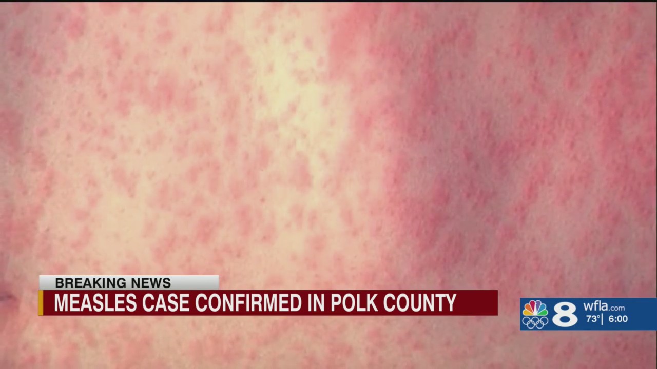 Measles spreads to Polk County amid growing outbreak in South Florida ...