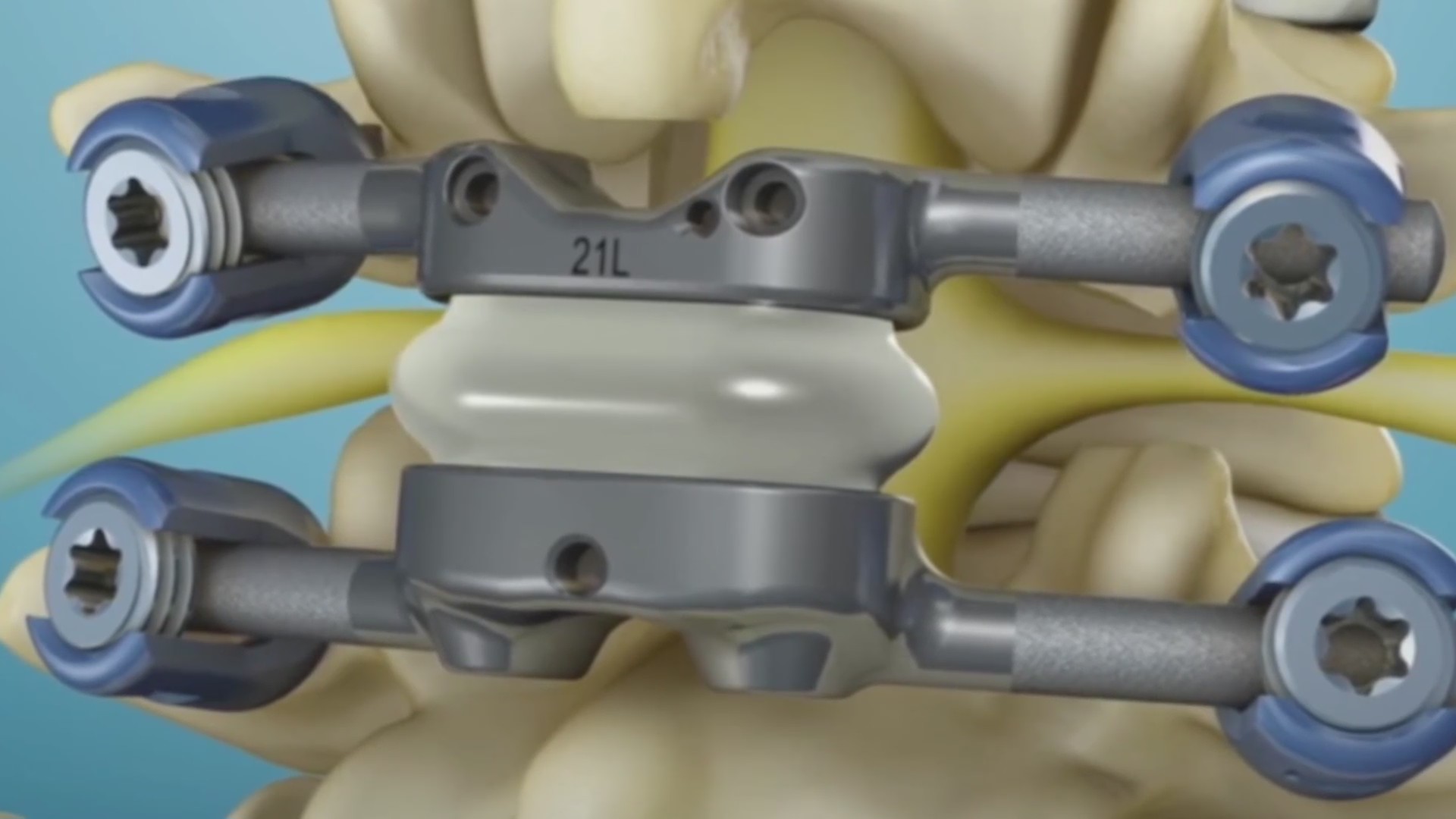 Novel TOPS back surgery now available in Colorado – FOX31 Denver