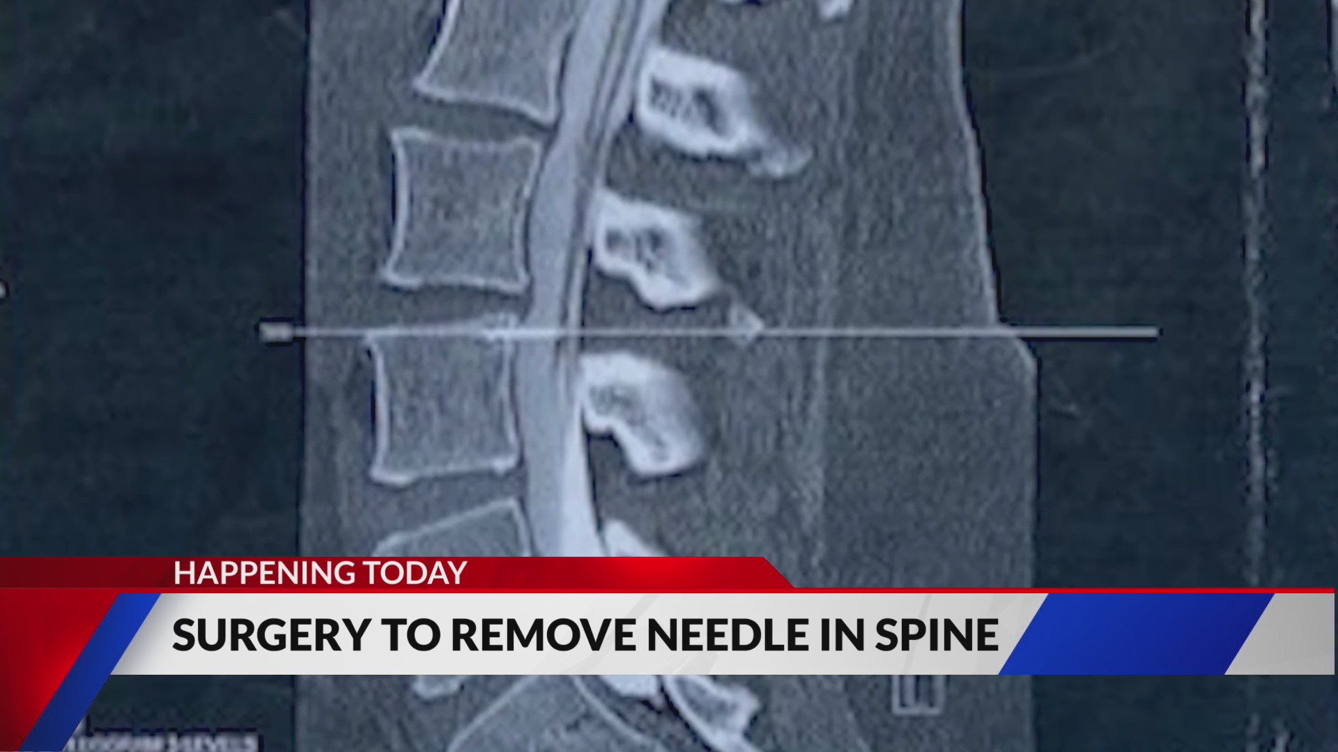 Illinois woman having surgery to remove needle in spine today – FOX 2
