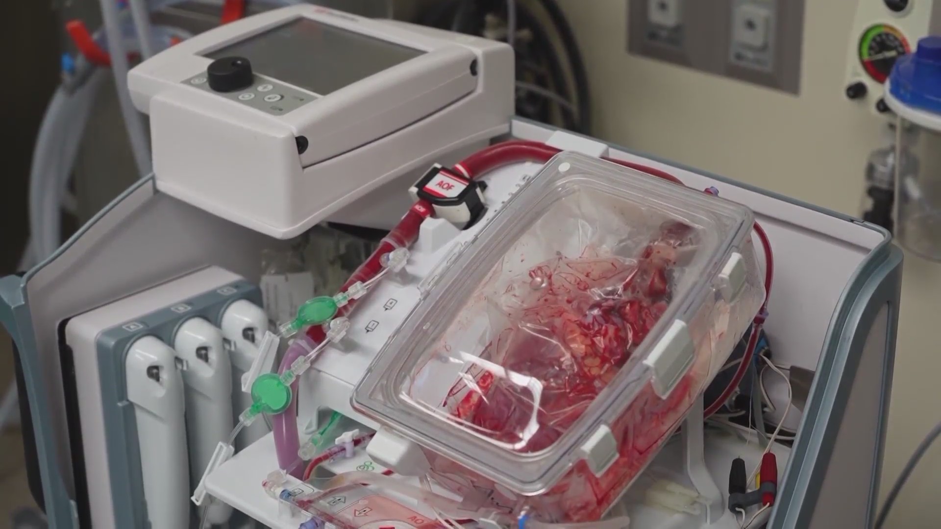 How a little box is preserving hearts and saving lives – WGN-TV