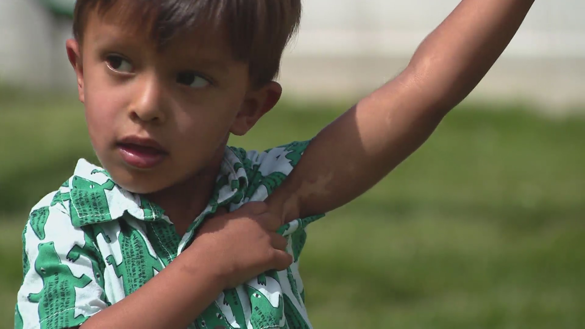 What looks like a birthmark could be a sign of a rare condition in ...