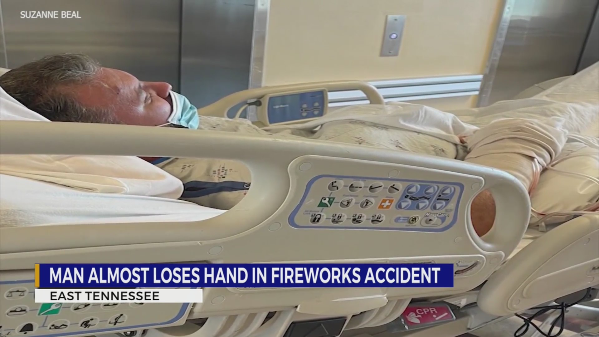 Man almost loses hand in fireworks accident – WKRN News 2