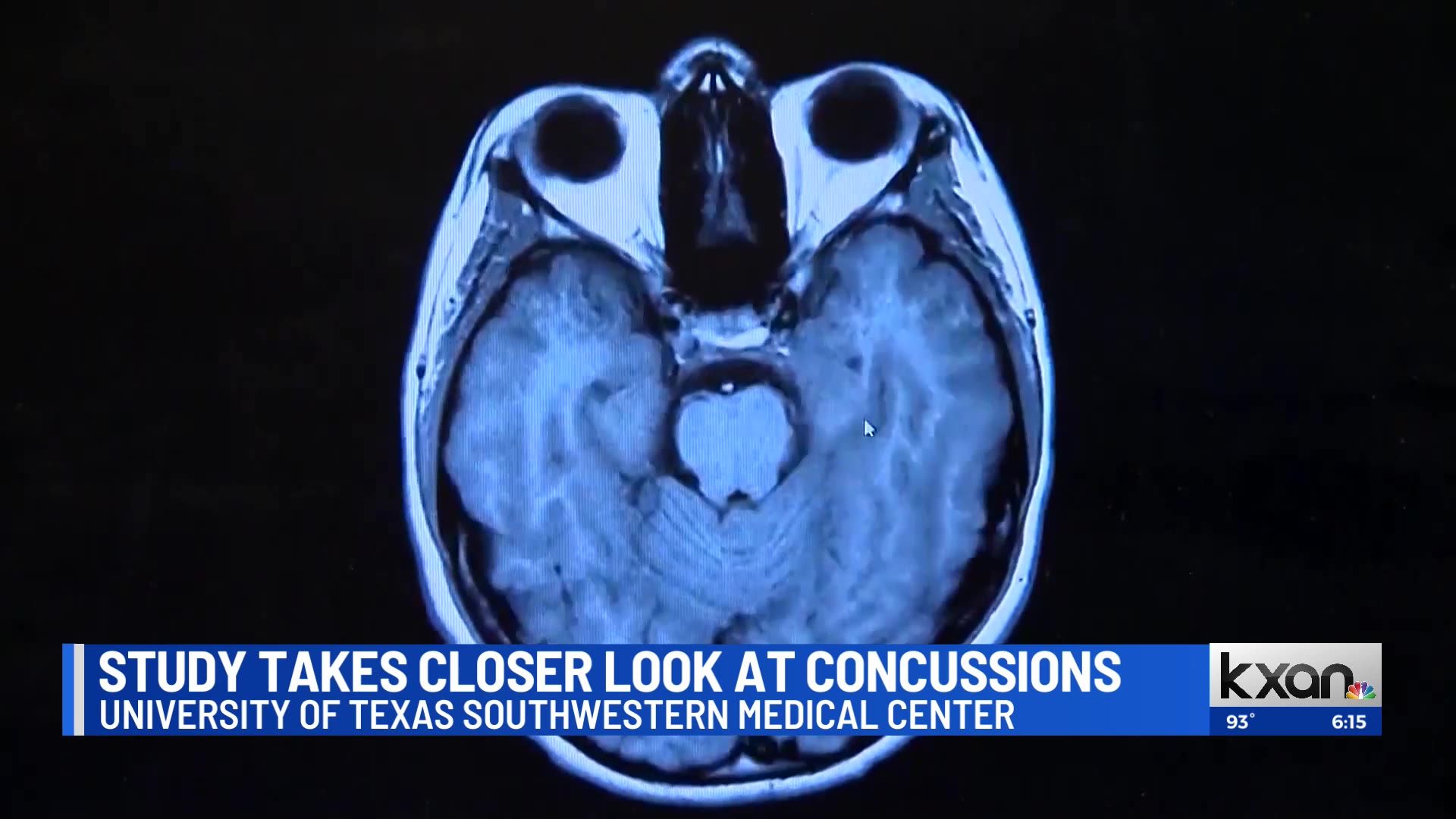 How does a concussion impact our brains? Texas university taking an in ...
