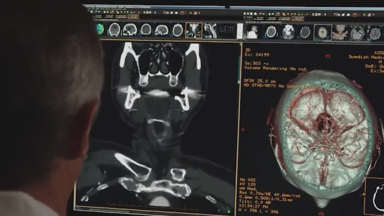 Health expert shares stoke symptoms to look out for – KOIN.com
