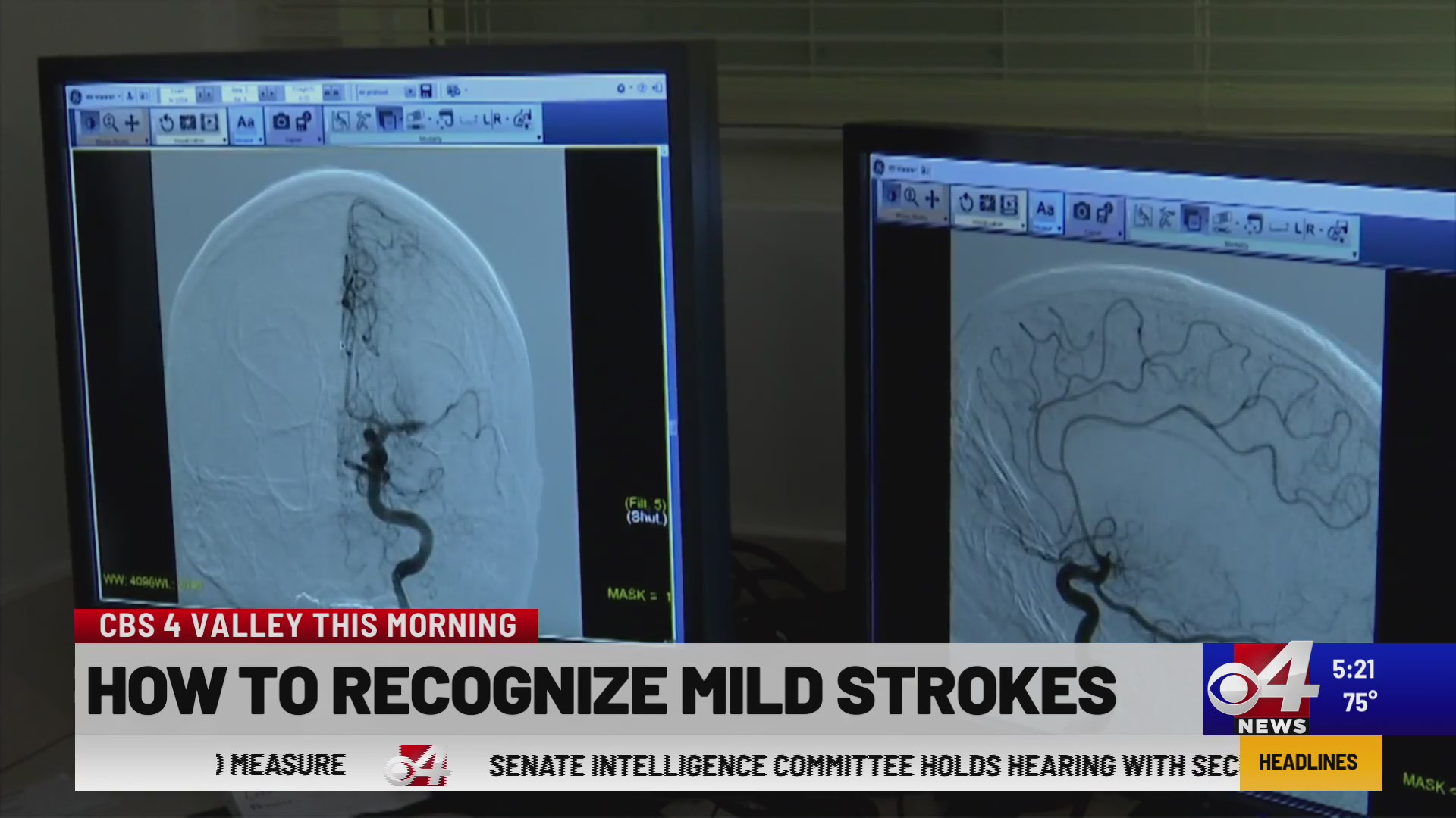 Recognizing mild strokes – KVEO-TV