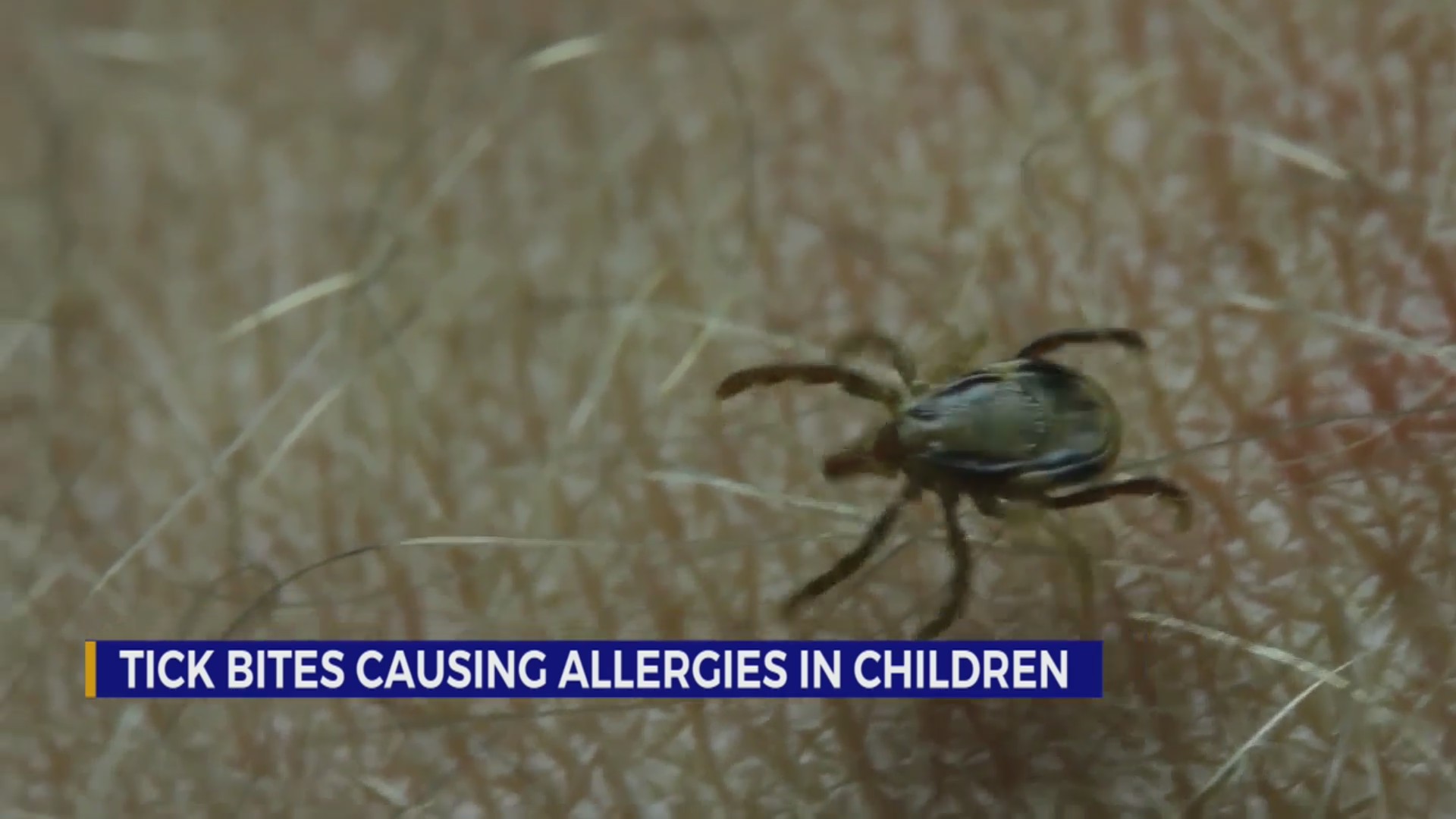 Tick bites causing allergies in children – WKRN News 2