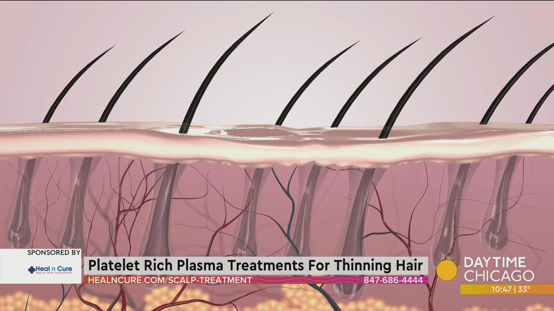 Platelet Rich Plasma Treatments For Thinning Hair – WGN-TV