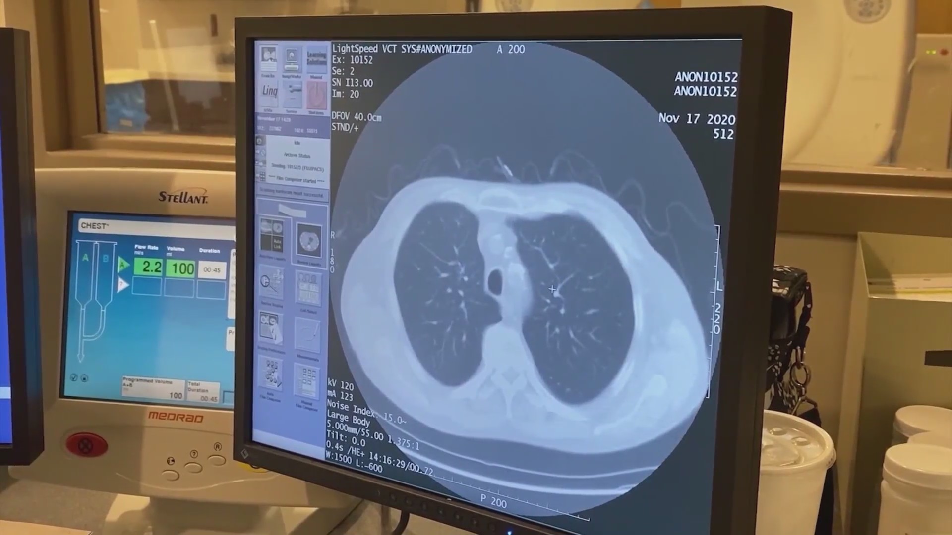 SSM Health Medical Minute: October is Lung Cancer Awareness Month – FOX 2