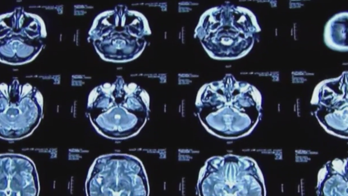 Drug slows Alzheimer’s but can it make a real difference? | Rush Hour ...