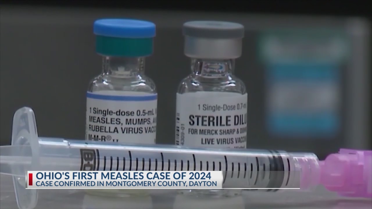 Ohio’s first measles case of 2024 reported – NBC4 WCMH-TV