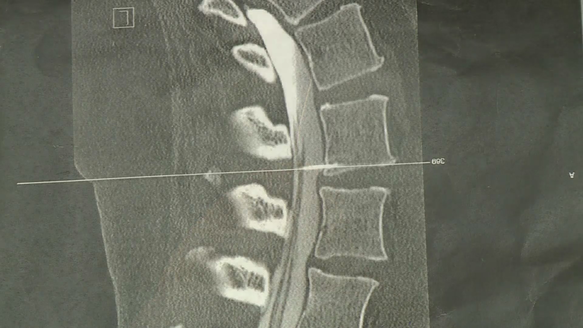 After 20 years, needle in Illinois woman’s spine removed – FOX 2