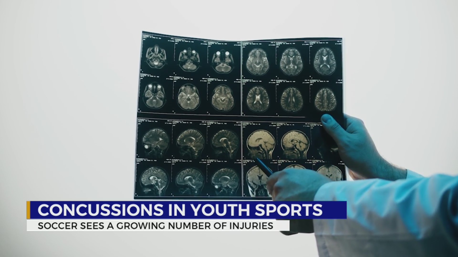 New treatments of concussions in young athletes – WKRN News 2