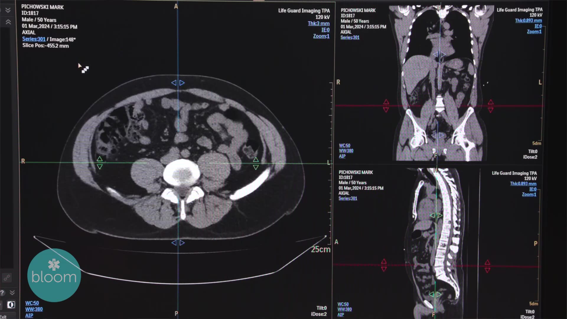 Early detection saves lives: Annual Life Guard Imaging scans – WFLA