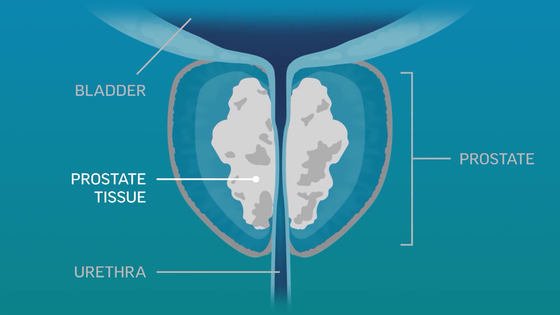 Treating Enlarged Prostate With Rezūm Water Vapor Therapy – KXAN Austin