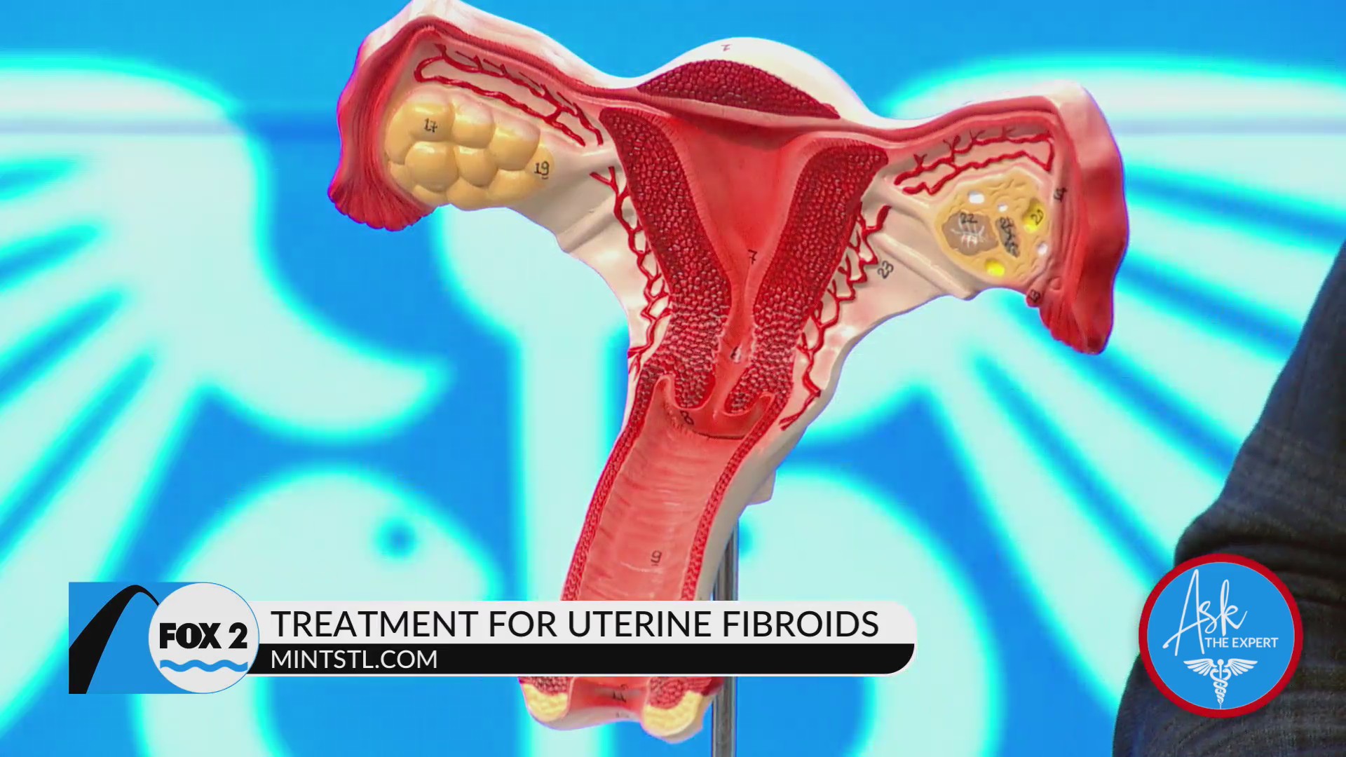 Find Uterine Fibroid Relief at Midwest Institute for Non-Surgical ...