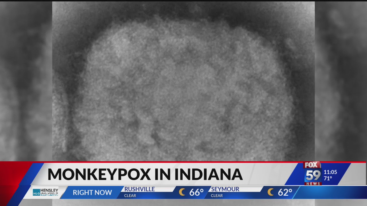 Indiana health officials identify first probable case of monkeypox in ...