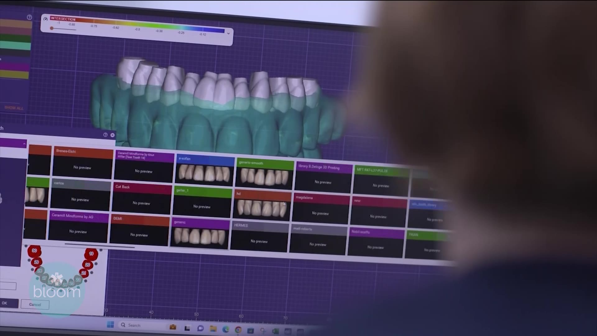 Life changing dental procedure with New Teeth Now – WFLA