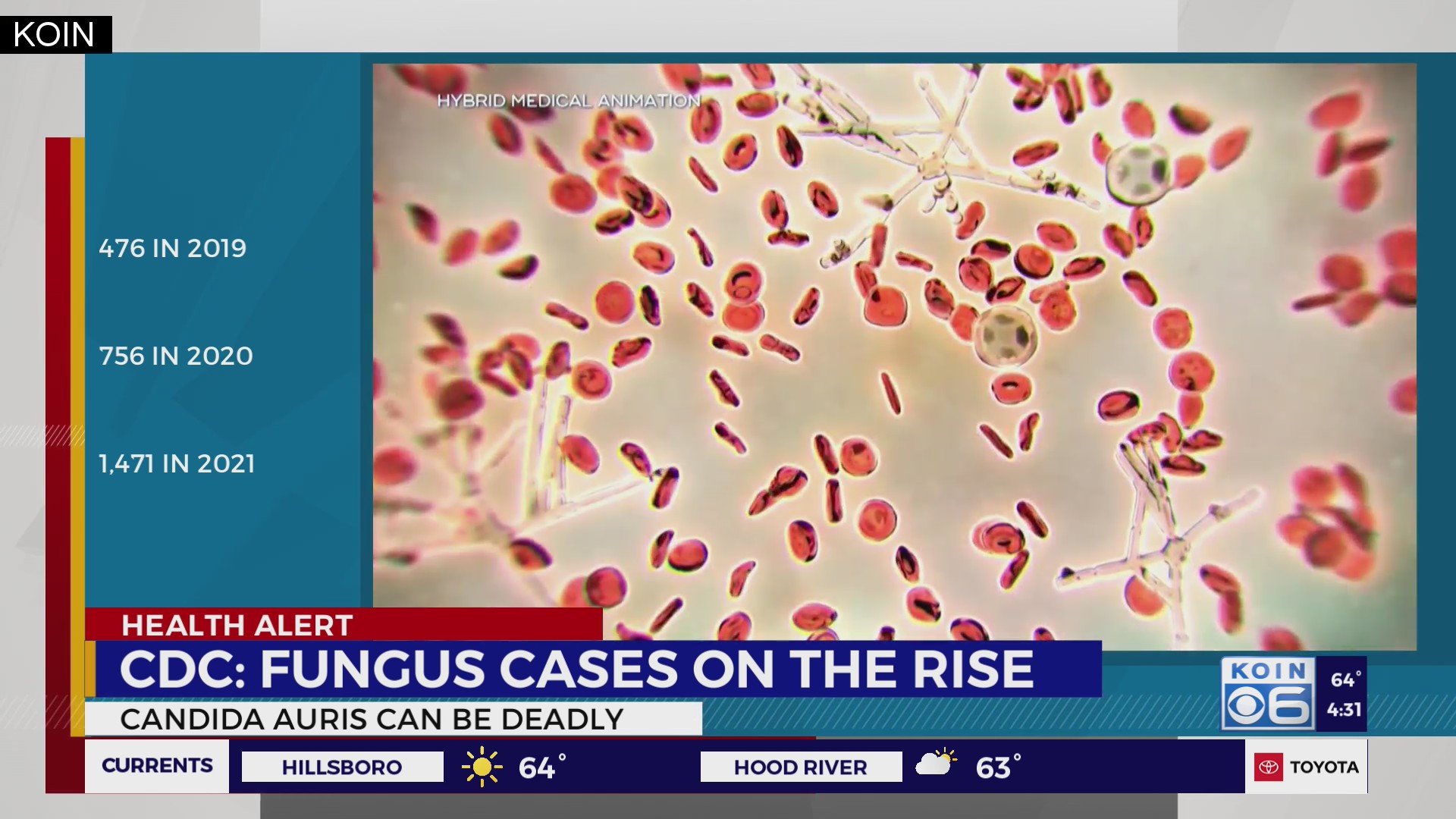 OHA confirms single outbreak of 3 cases of fungus Candida auris – KOIN.com