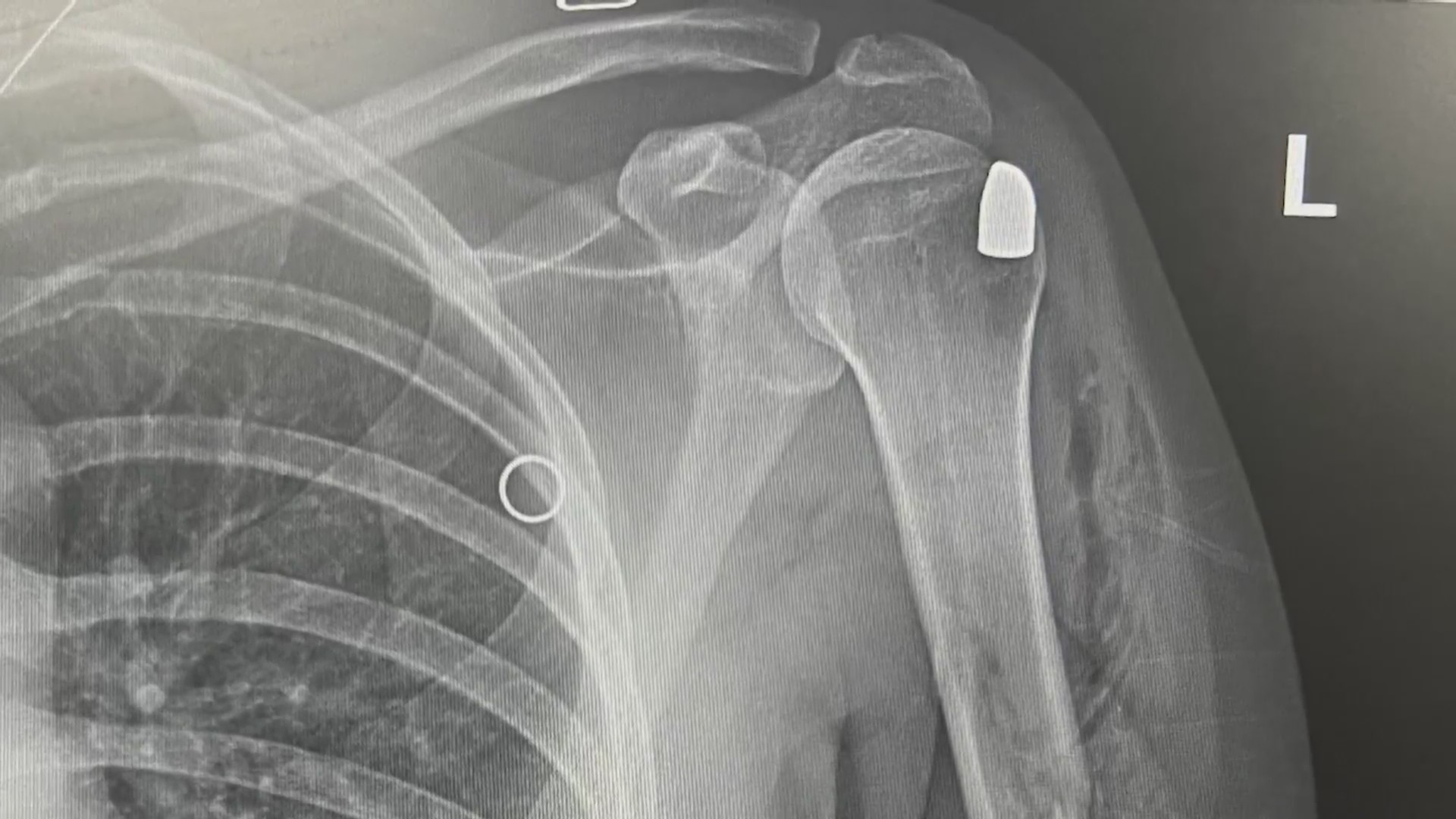Bullet barely misses sleeping kids, hits Aurora mom – FOX31 Denver