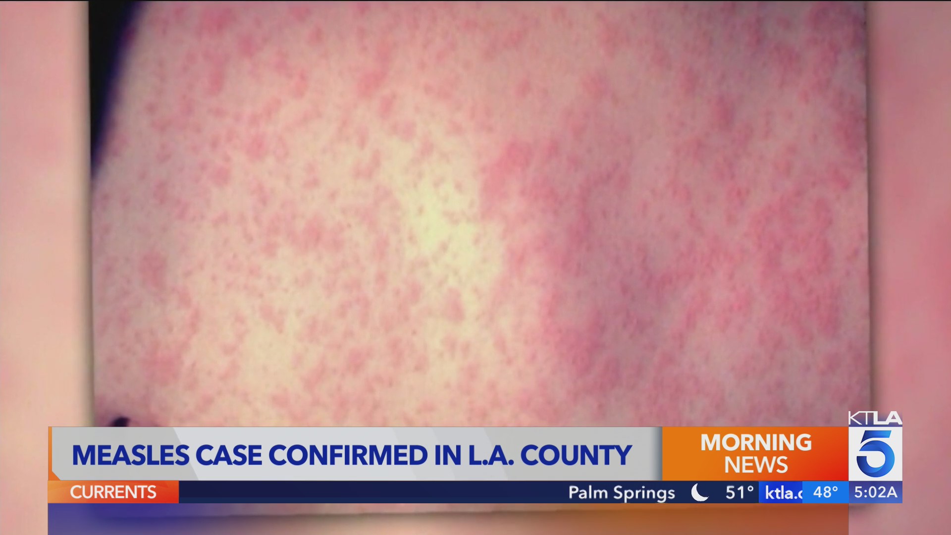 Measles detected in Los Angeles County – KTLA