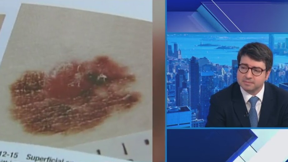 The ABCs of identifying possible melanoma – PIX11 The ABCs of identifying possible melanoma – PIX11
