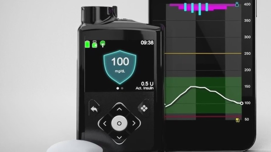 FDA-approved insulin pump helping kids, adults with type 1 diabetes ...