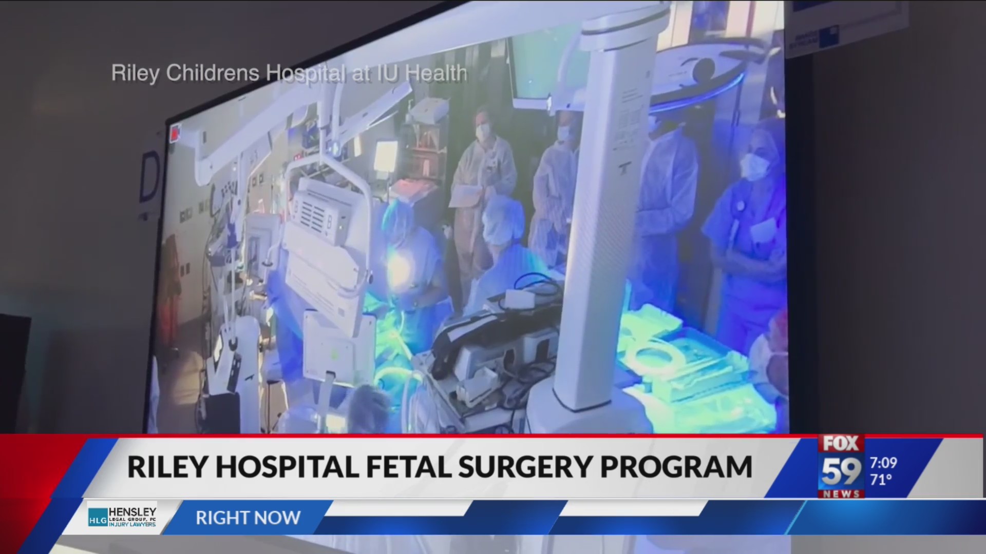 Riley Children’s Health fetal surgery program – Fox 59