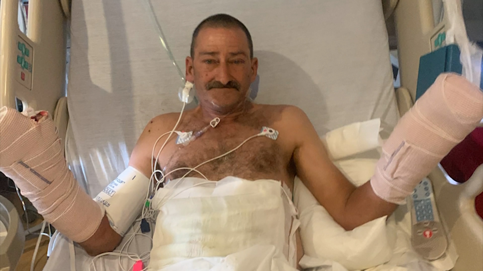 Orlando man loses multiple fingers in firework accident – WFLA
