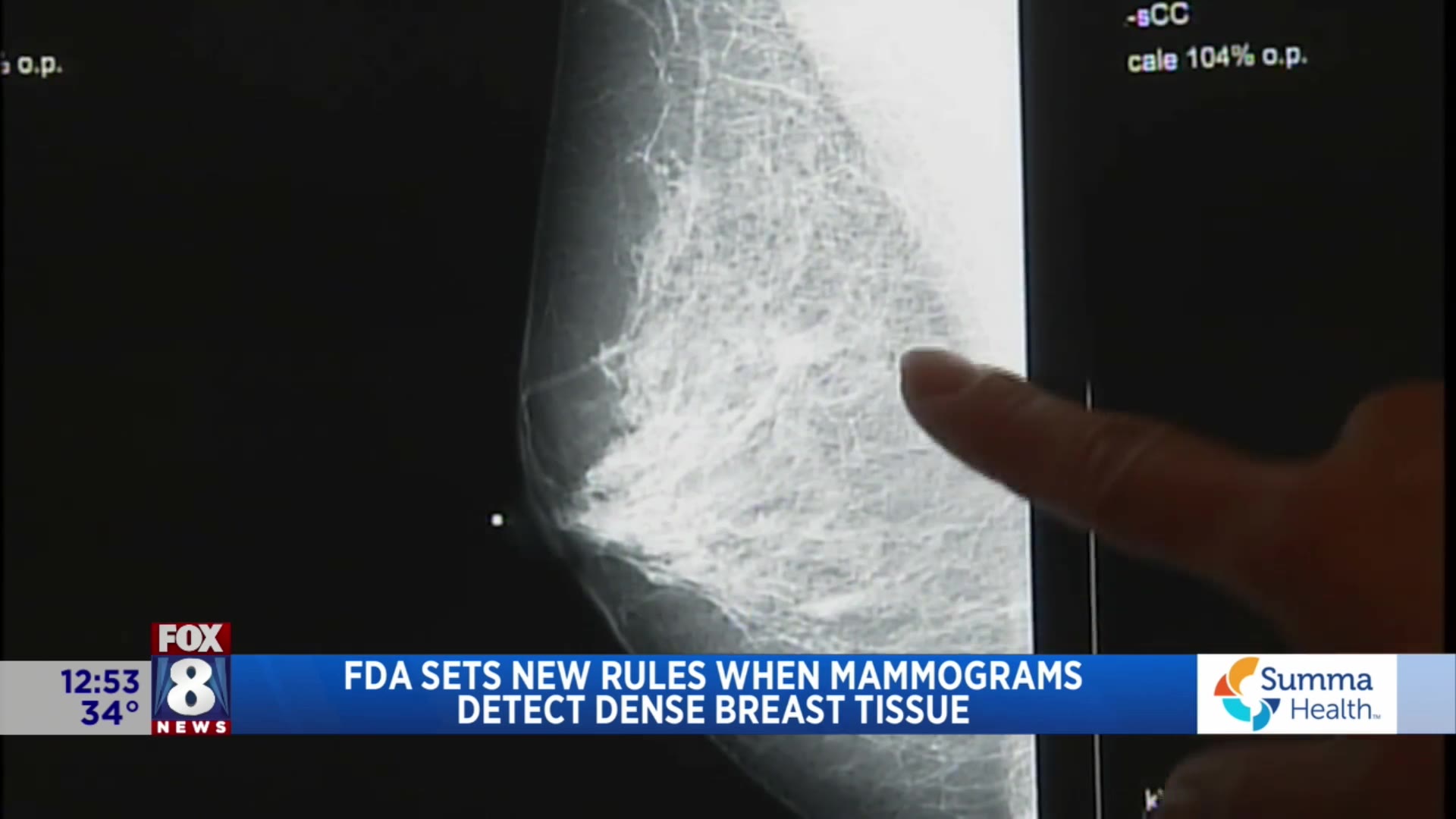 Fda Sets New Rules When Mammograms Detect Dense Breast Tissue Fox 8