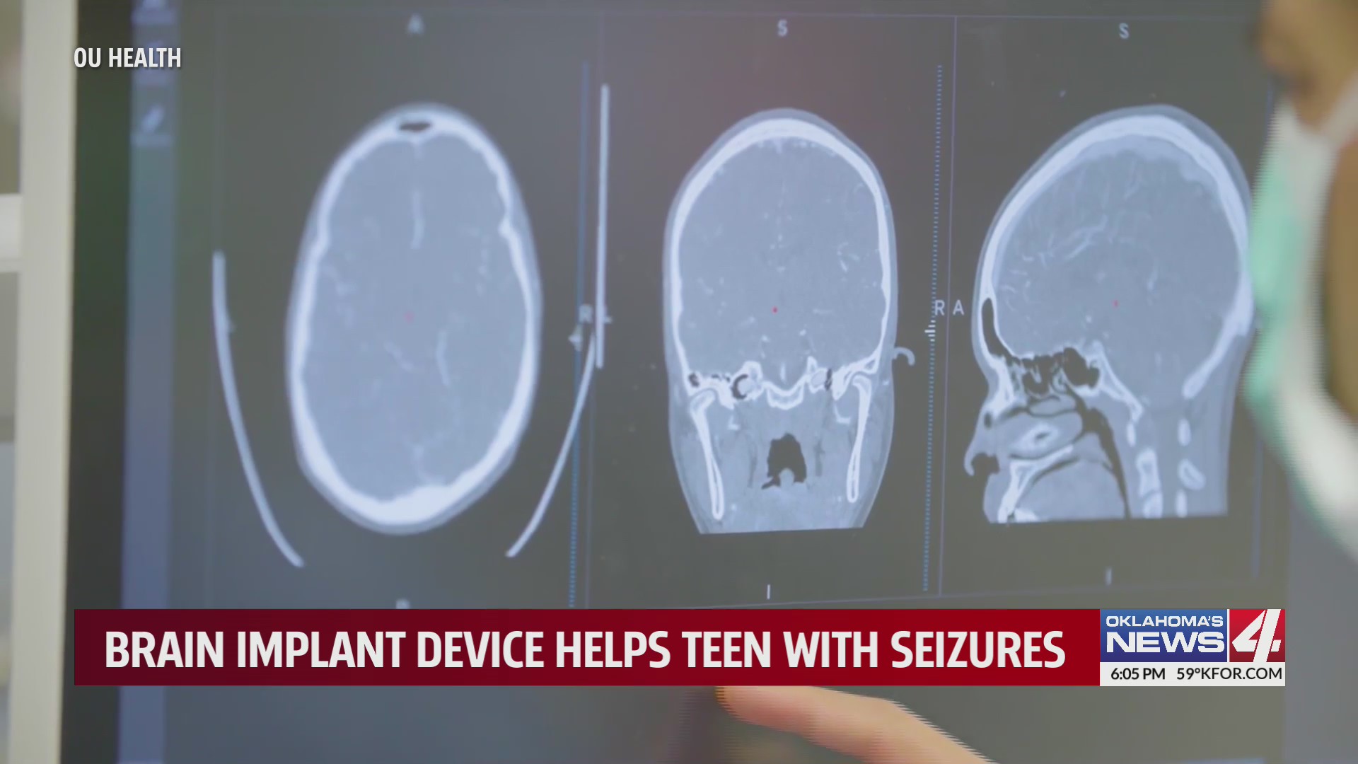 Brain implant device helps teen with seizures – KFOR.com Oklahoma City