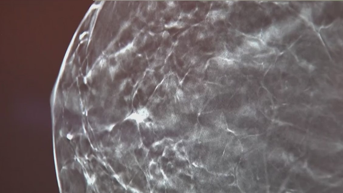 Breast Cancer Awareness: How early should you start getting mammograms ...