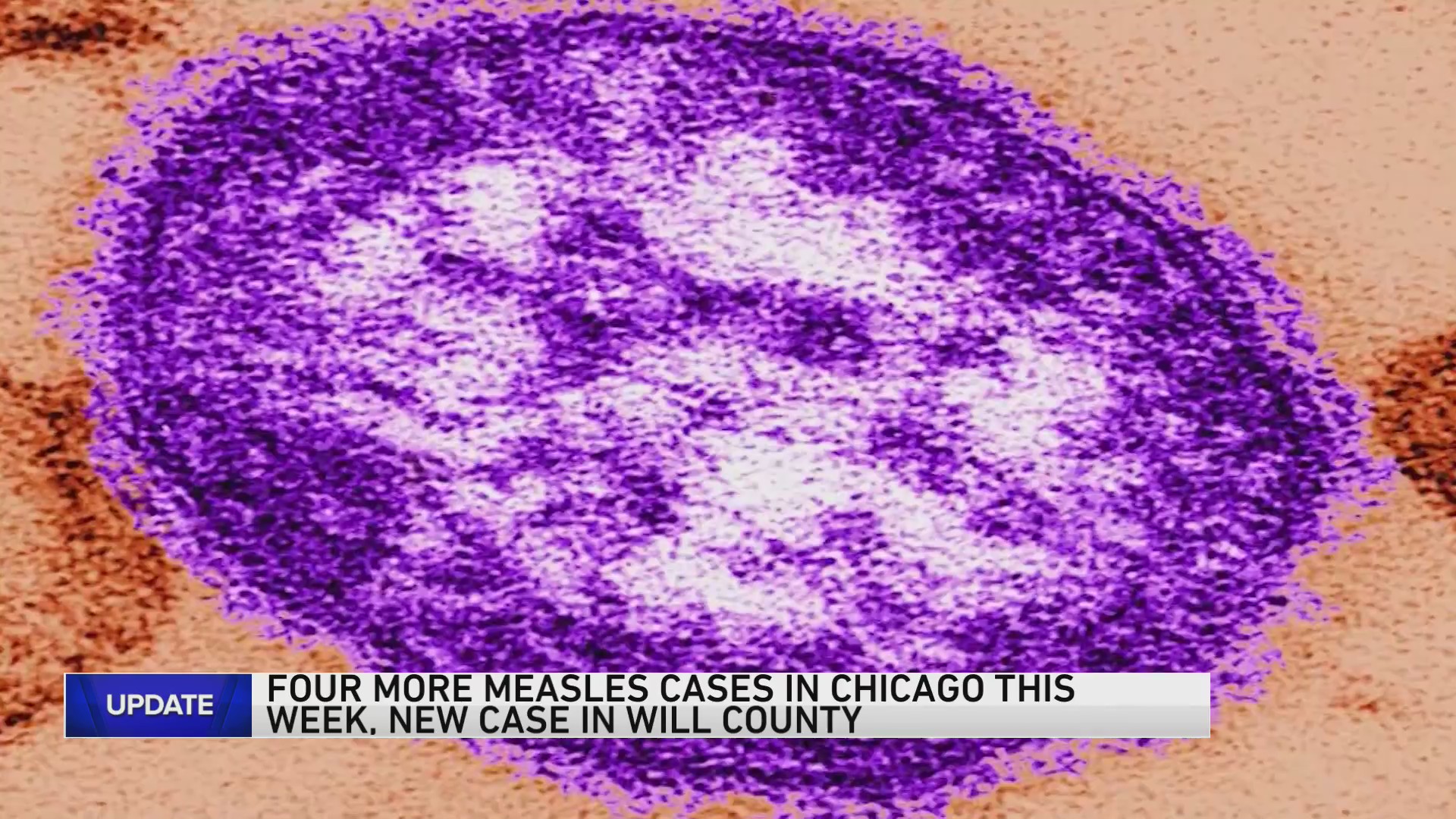 Measles in Chicago area update – WGN-TV