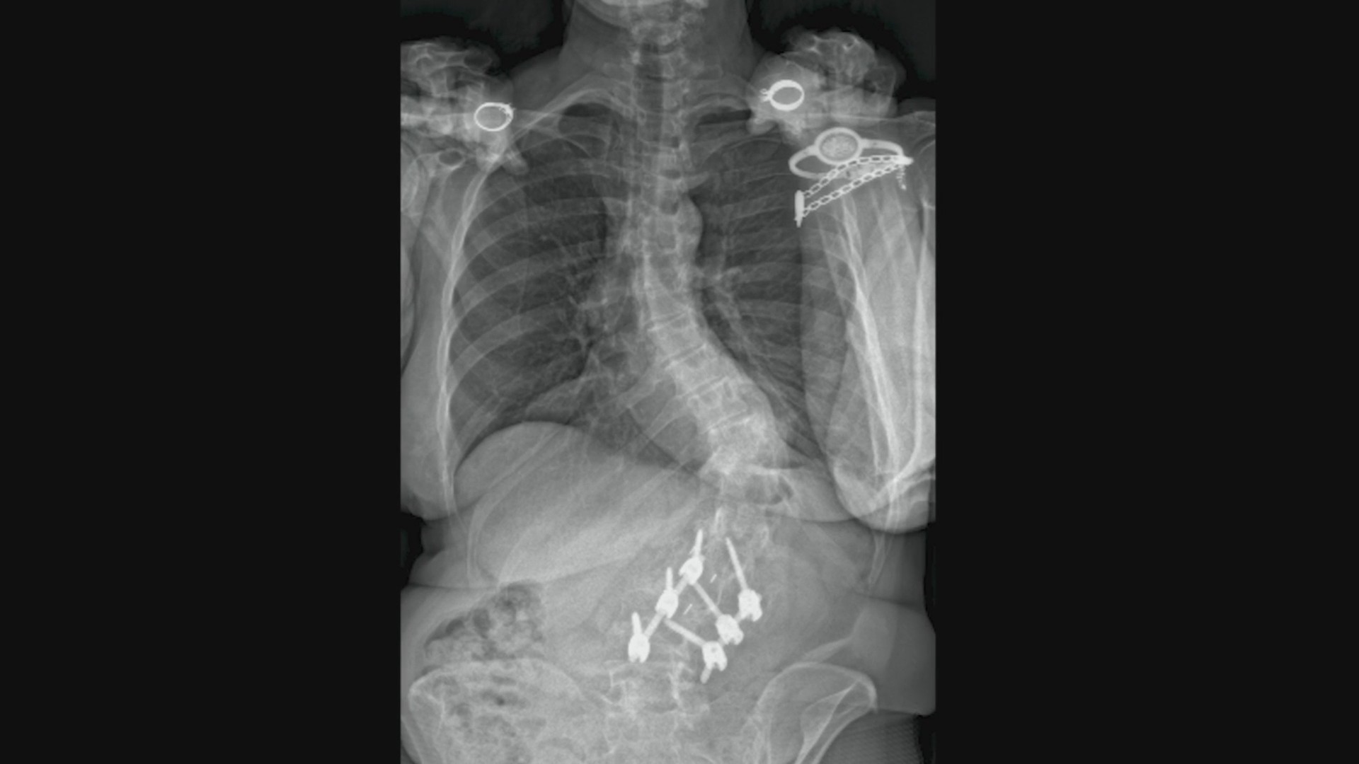 Colorado woman bedridden with severe scoliosis gets life back after ...