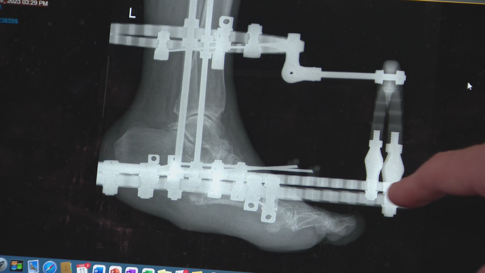 A scar instead of a loss of limb: Loyola doctor works to spare diabetes ...