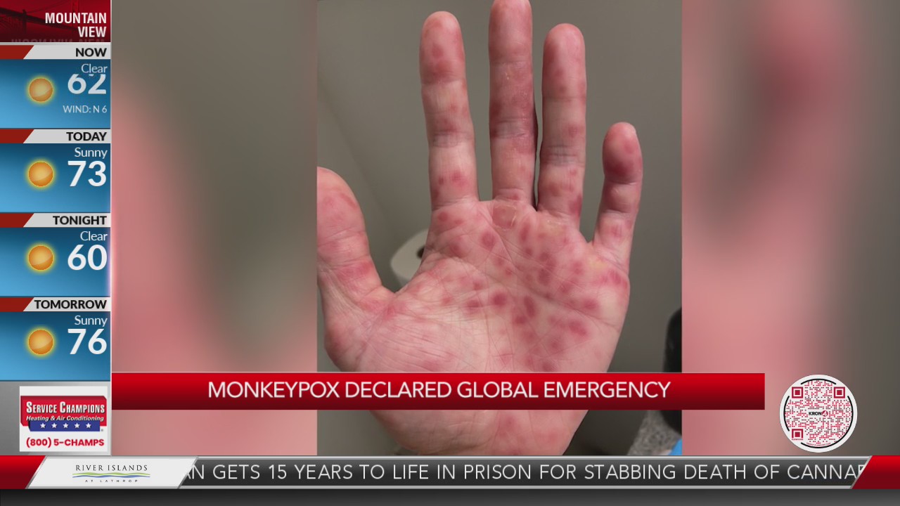 Bay Area man shares story of monkeypox recovery – KRON4
