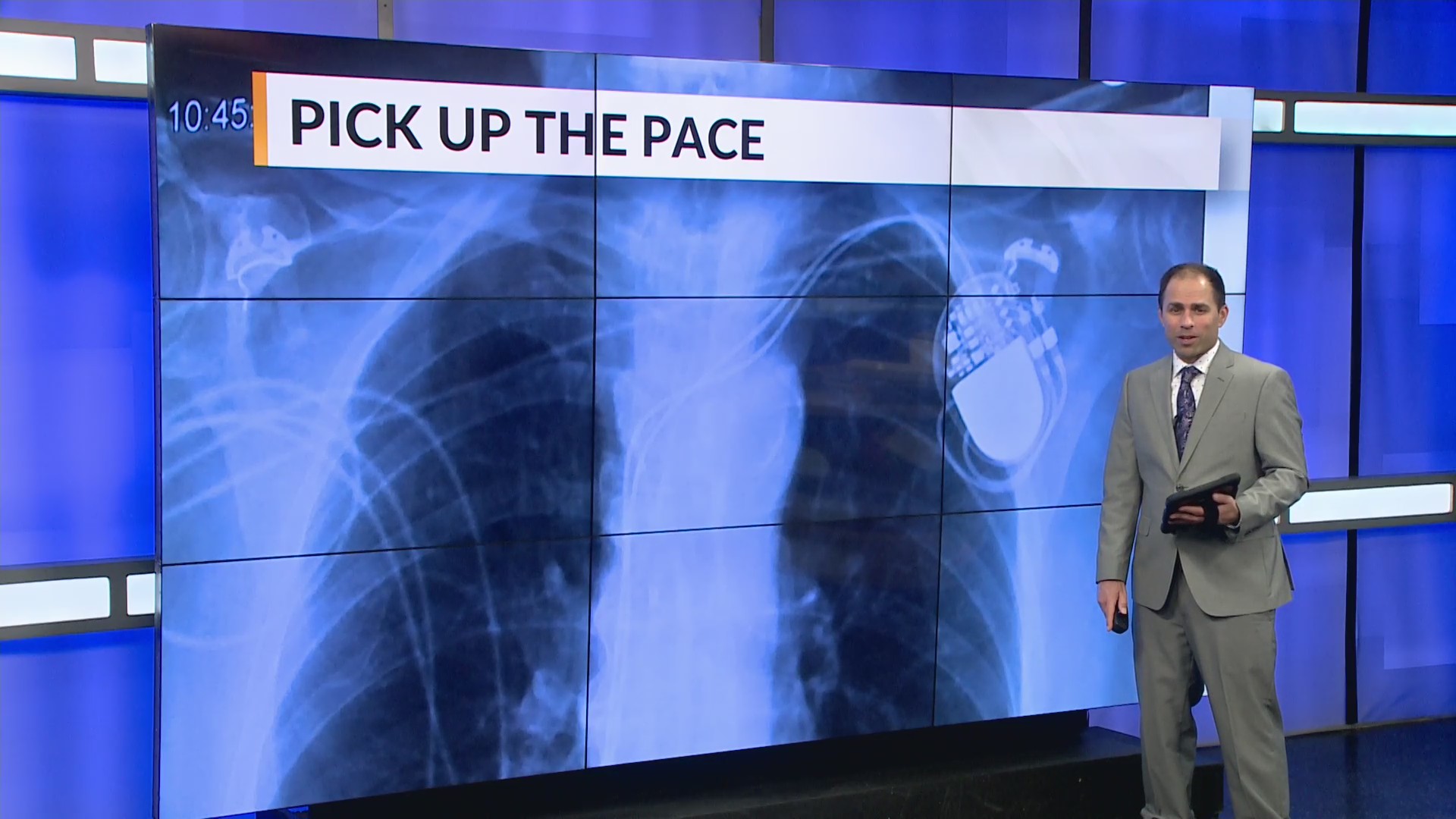 Giving your heart a boost: Pacemakers vs. ICDs – KX NEWS