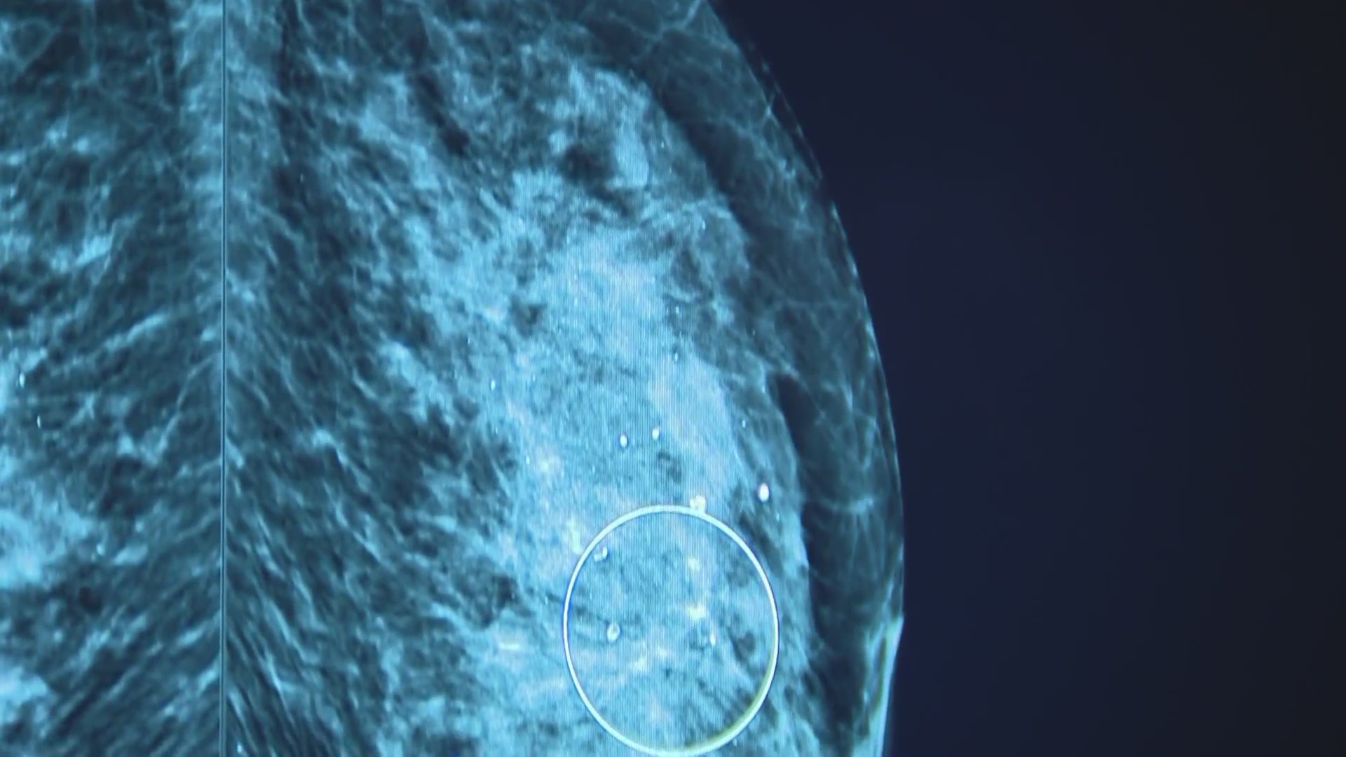 FDA sets new guidelines for mammograms – MyStateline | WTVO News ...