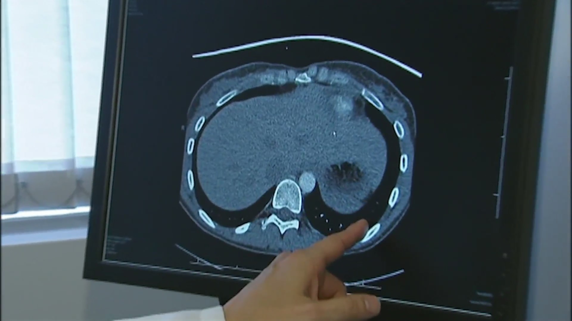 The growing issue of blood clots – MyStateline | WTVO News, Weather and ...