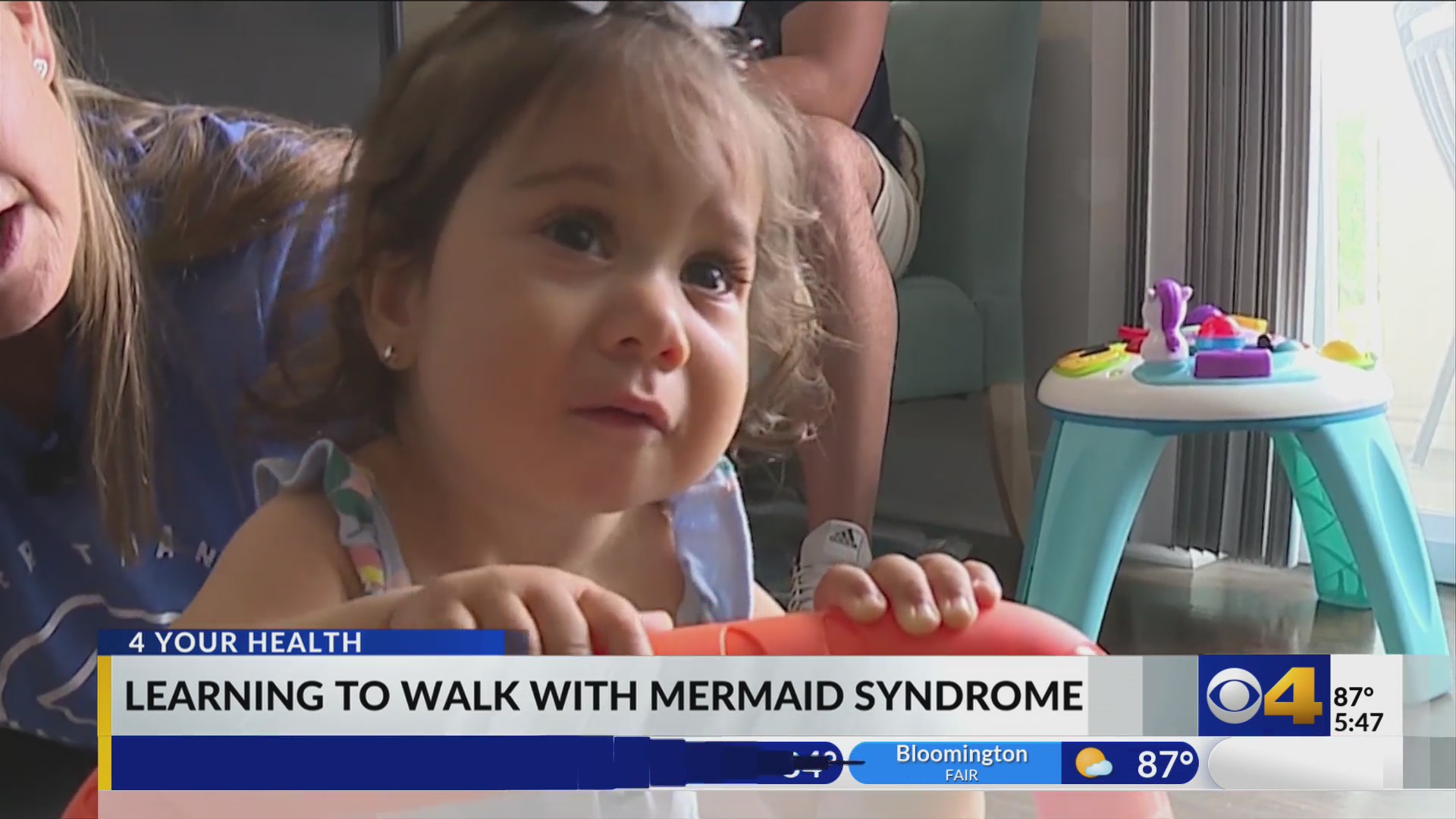 Girl with Mermaid Syndrome learning to walk – WTTV CBS4Indy