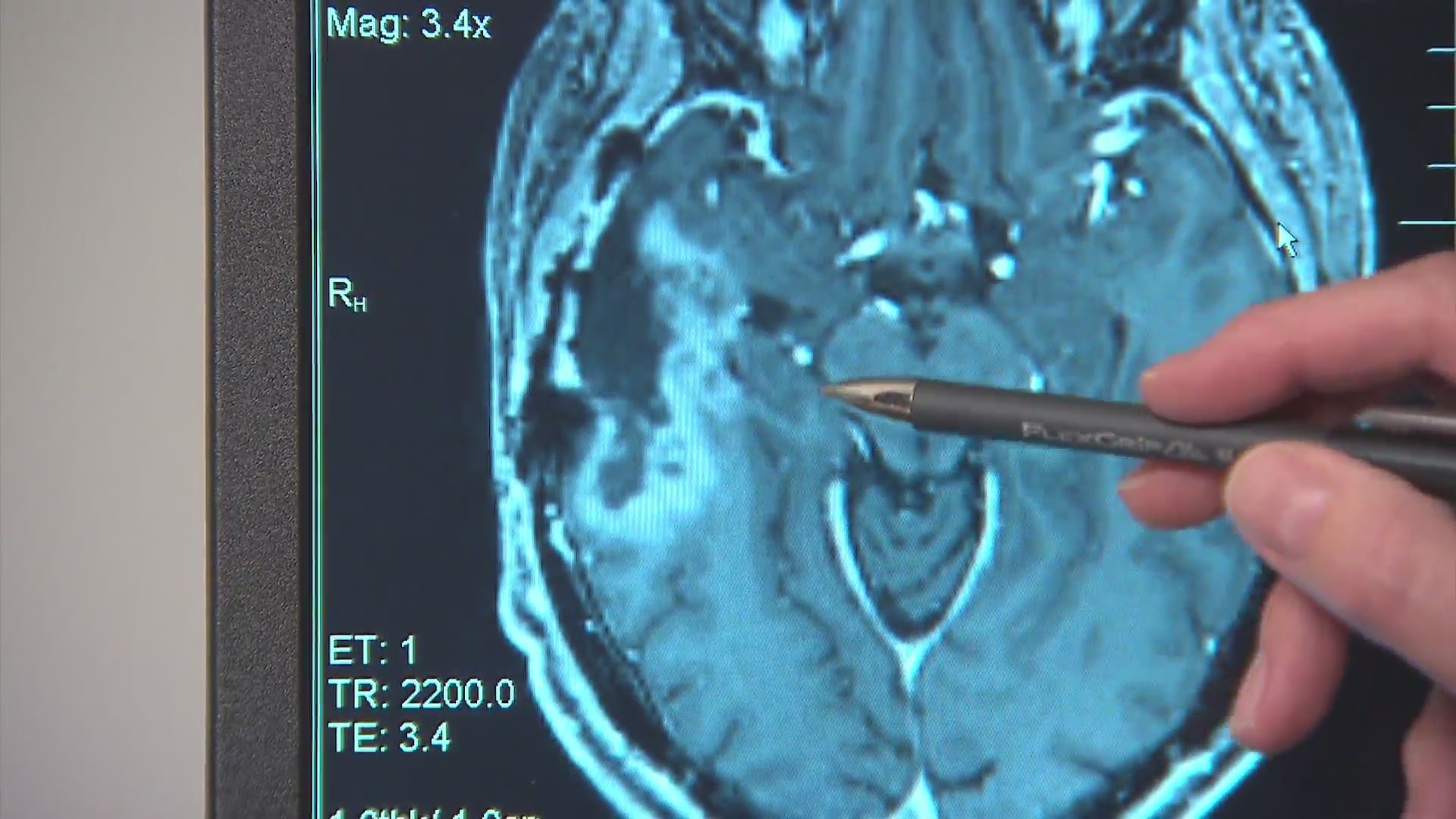 Study shows progress in vaccine development for deadly brain tumor – WGN-TV