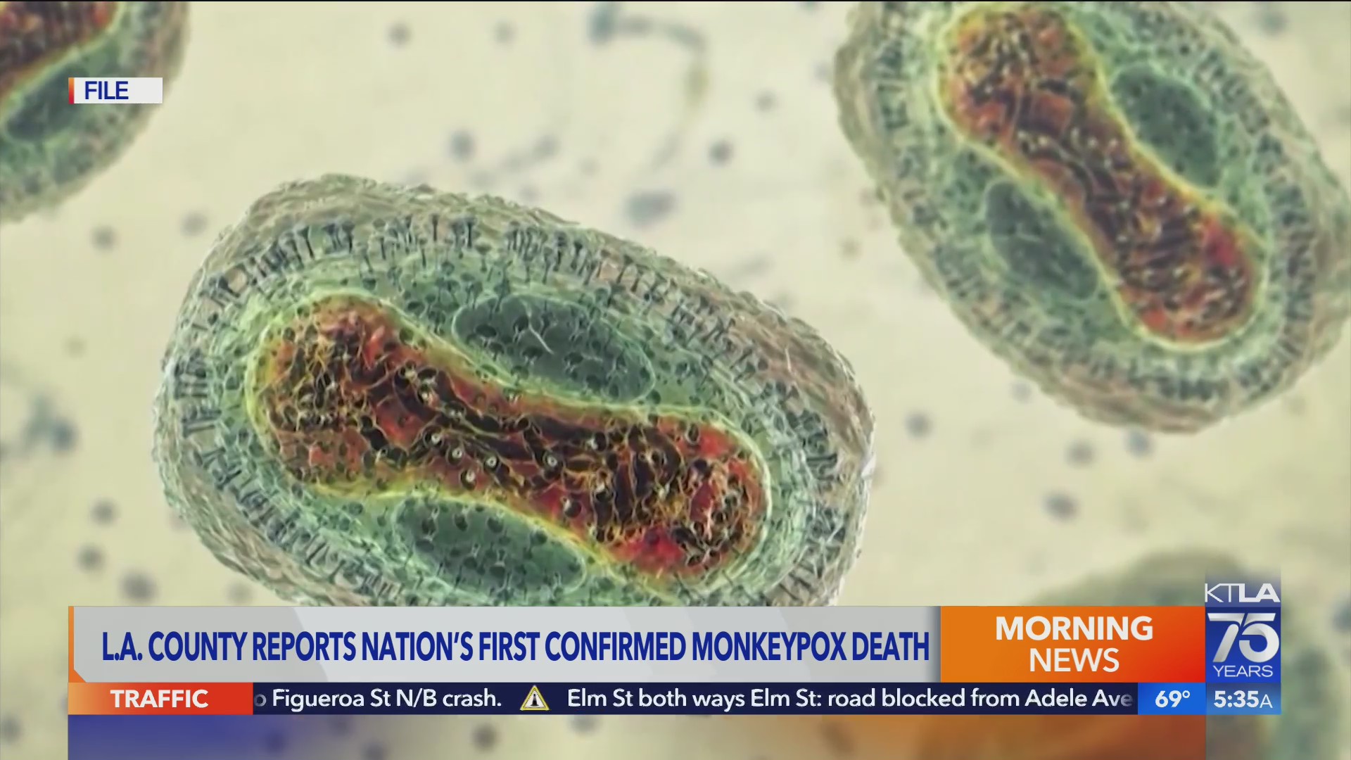 L.A. County confirms 1st monkeypox death – KTLA