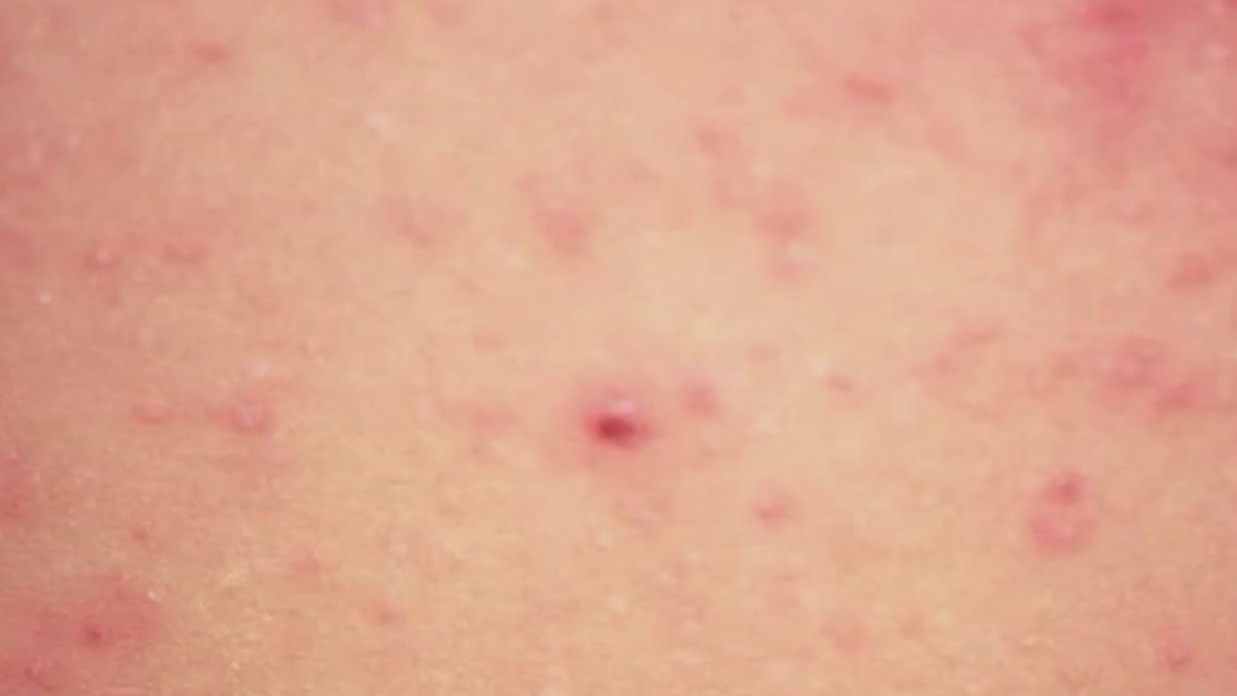 Chicago resident with measles is first confirmed case in city since ...