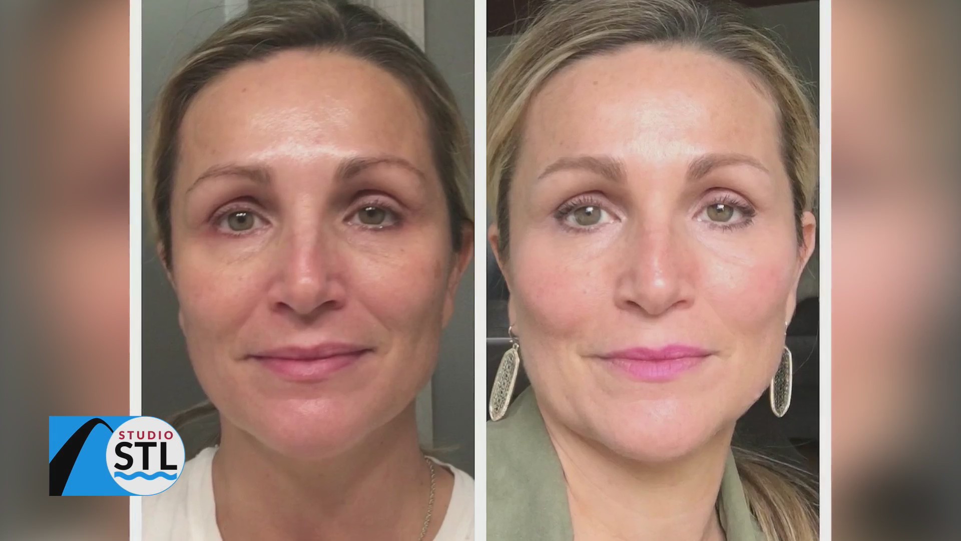 Medspa Monday with Face & Body: Fuzion in South County offers medically ...