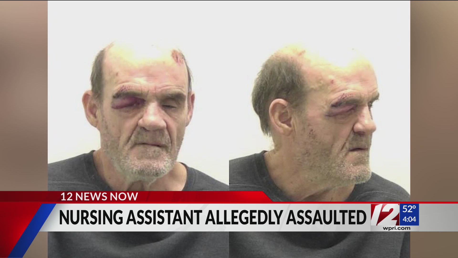 Nursing assistant assaulted by patient at RI Hospital – WPRI.com