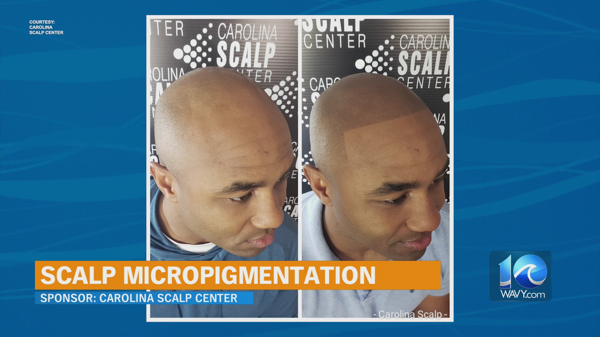 Scalp Micropigmentation – WAVY.com